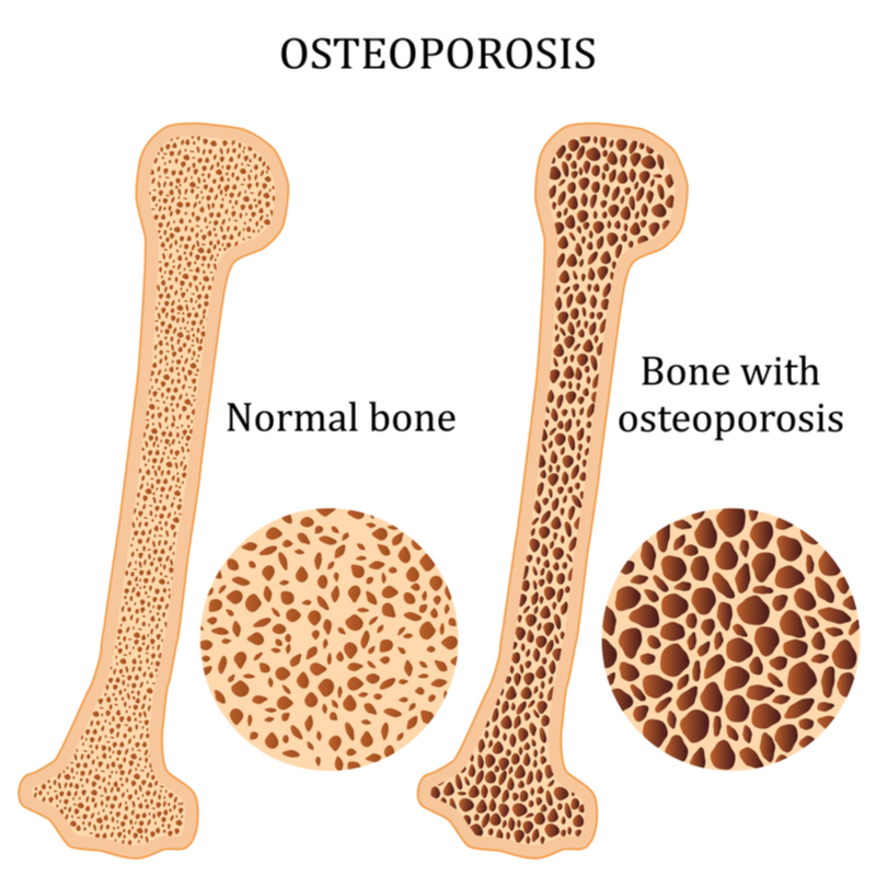 Joint Pain After Running Is This The Sign Of Osteoporosis 
